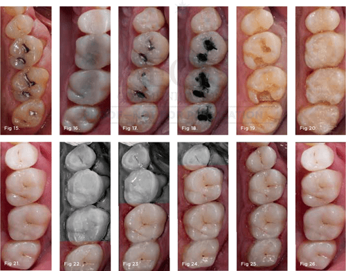 Vonlays: a conservative esthetic alternative to full-coverage crowns ...