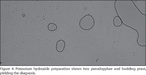 Figure 3 from A full-term infant with rash at birth. Congenital ...