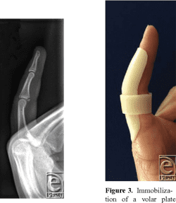Figure 3 from Volar Plate Avulsion Injury | Semantic Scholar