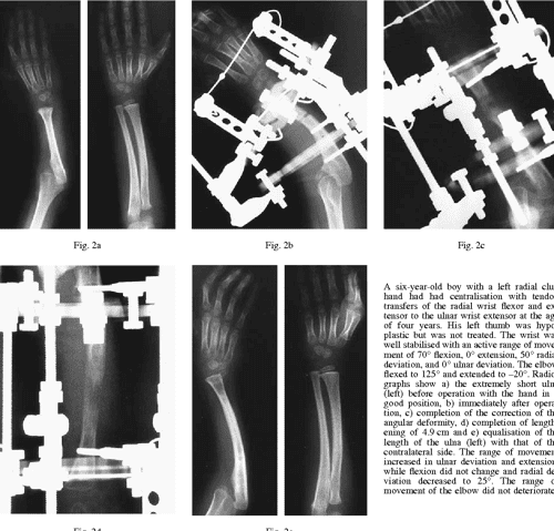 Figure 1 from Residual deformity in congenital radial club hands after ...