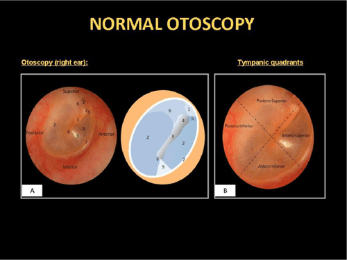Figure 21 from Eardrum color and the imaging diagnosis of middle ear ...