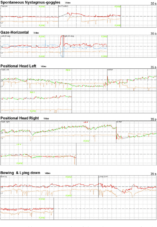 PDF Central Apogeotropic Direction Changing Positional Nystagmus Due pdf-central-apogeotropic-direction-changing-positional-nystagmus-due