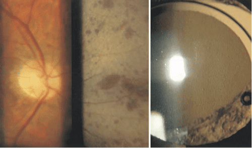 Ultimate soft-shell technique and AcrySof Monarch injector cartridges ...