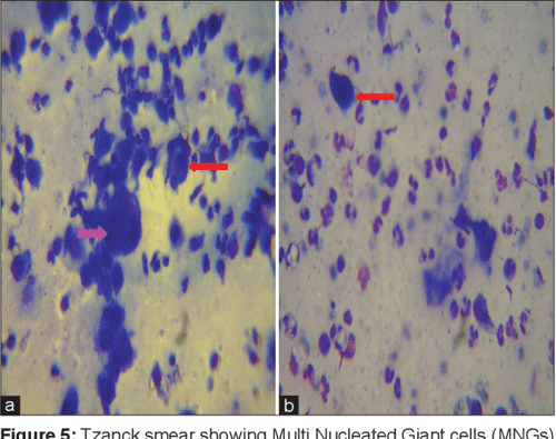 Diagnostic value of Tzanck smear in various erosive, vesicular, and ...