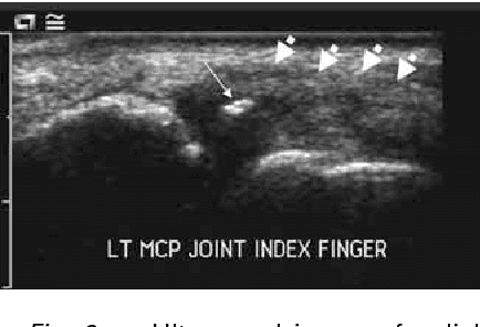 Figure 1 from Imaging in index finger radial collateral ligament injury ...