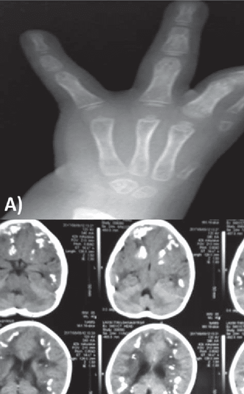 Figure 1 from A Child with Roberts Syndrome: A Case Report | Semantic ...