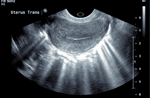 Evidence-Based Reporting of Suspected Retained Products of Conception ...