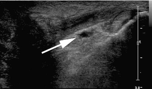 Figure 2 from Fibroma of tendon sheath located within Kager's triangle ...
