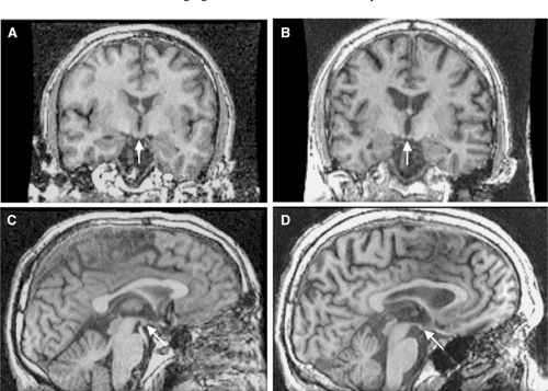 Figure 1 from Neuroimaging of the Wernicke-Korsakoff syndrome ...
