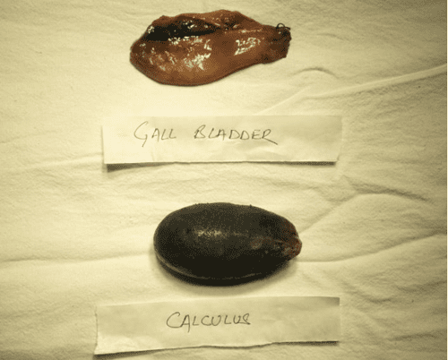 Giant gall stone: a rare finding performed with open cholecystectomy ...