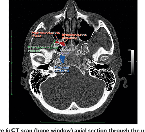 Figure 5 from Clinical functional anatomy of the pterygopalatine ...