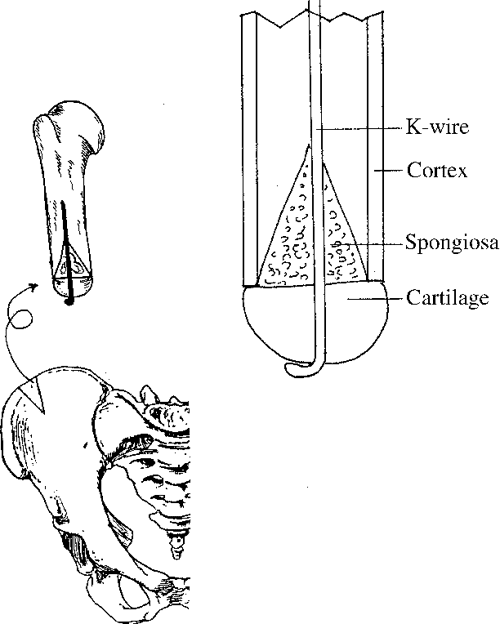 Figure 1 from Osseous overgrowth in congenital amputations of the upper ...