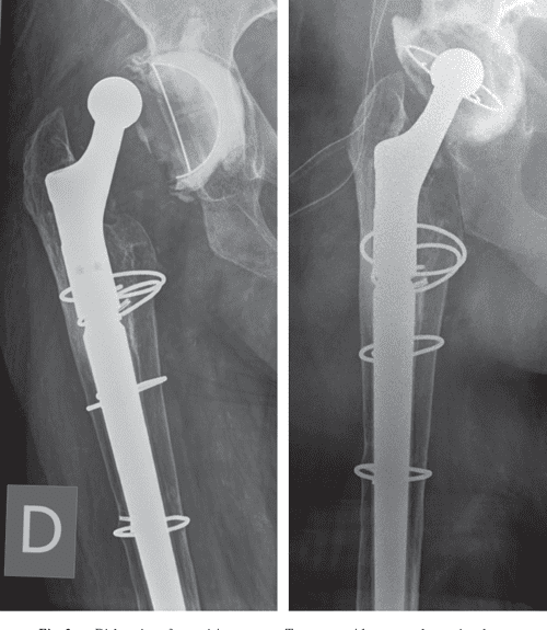 Figure 1 from Constrained acetabular liners in hip revision surgery . A ...
