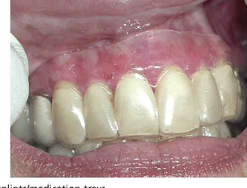 Oral lichen planus and lichenoid mucositis. | Semantic Scholar