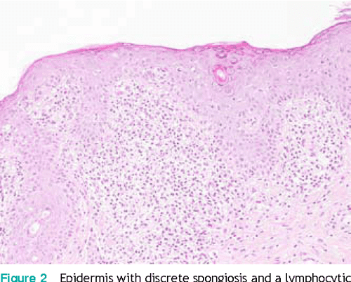 Figure 1 from [Adult blaschkitis (lichen striatus) in a patient treated ...