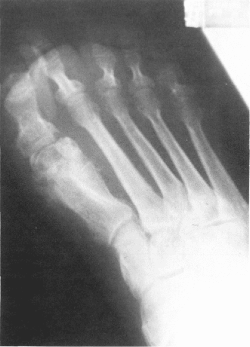 Figure 4 from Hoffman Procedure in the Ulcerated Diabetic Neuropathic ...