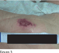 Figure 5 from Wound care Unstageable pressure ulcers Eschar Key ...