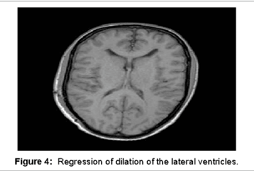 Figure 1 from Diagnostic Difficulties in Slit Ventricle Syndrome ...