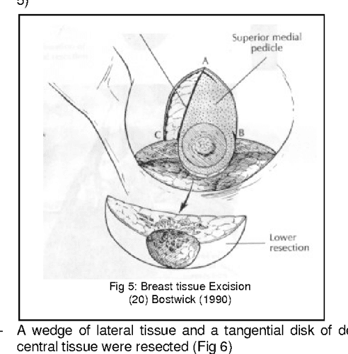 Superomedial Pedicle Mammaplasty The Logical Extension Of The