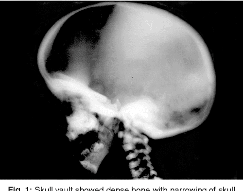 Figure 1 from Osteopetrosis (Marble Bone Disease): A Rare Disease in ...