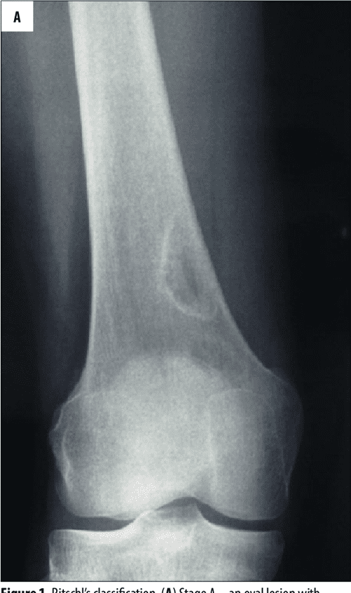 Cortical fibrous defects and non-ossifying fibromas in children and ...