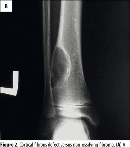 Cortical fibrous defects and non-ossifying fibromas in children and ...