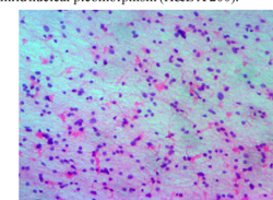 Figure 1 from UTILITY OF SQUASH CYTOLOGY IN DIAGNOSING CNS LESIONS ...