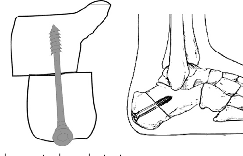 Calcaneal osteotomy in the treatment of adult acquired flatfoot ...