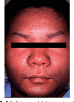 Table 2 from Drug-induced Hypersensitivity Syndrome(DIHS): A Reaction ...