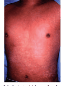 Table 2 from Drug-induced Hypersensitivity Syndrome(DIHS): A Reaction ...