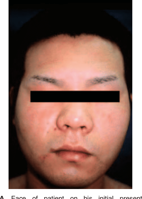 Table 2 from Drug-induced Hypersensitivity Syndrome(DIHS): A Reaction ...