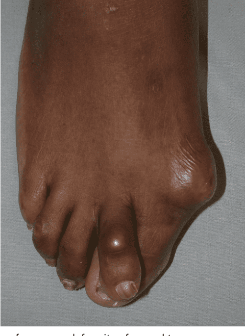 Figure 10 from The crossover toe and valgus toe deformity. | Semantic ...