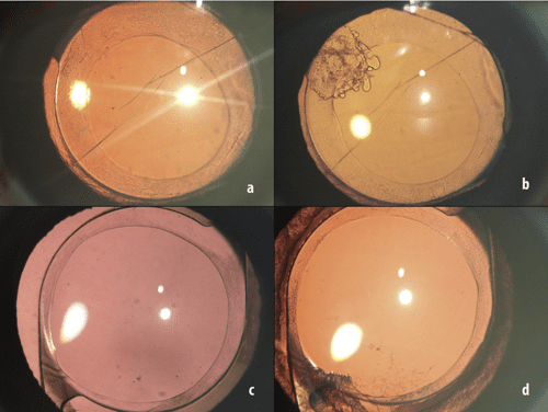 Incidence and influence of posterior capsule striae on the development ...
