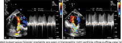 Figure 2 from Warden repair for superior sinus venosus atrial septal ...