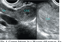 Figure 4 from TUBAL RING SIGN OF ECTOPIC PREGNANCY VERSUS CORPUS LUTEUM ...