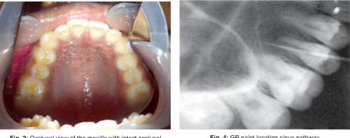 Figure 6 from Occult Caries: The Hidden Truth | Semantic Scholar