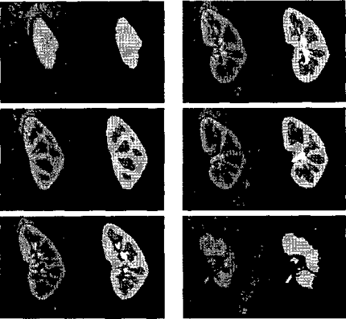 [pdf] Interactive Graph Cuts For Optimal Boundary And Region Segmentation Of Objects In N D Images