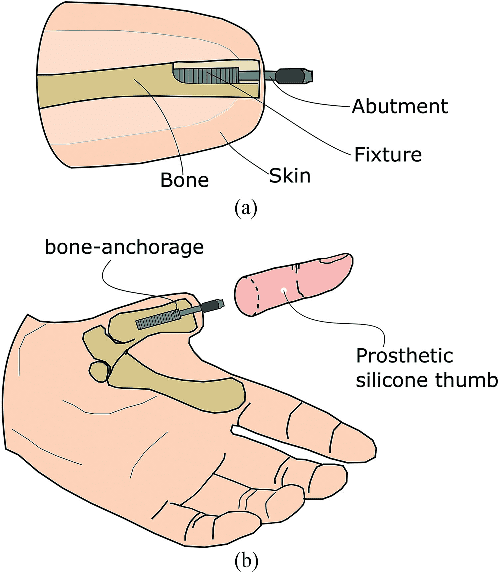 Figure 6 from Treatment of the Partial Hand Amputation: An Engineering ...