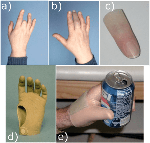 Figure 6 from Treatment of the Partial Hand Amputation: An Engineering ...