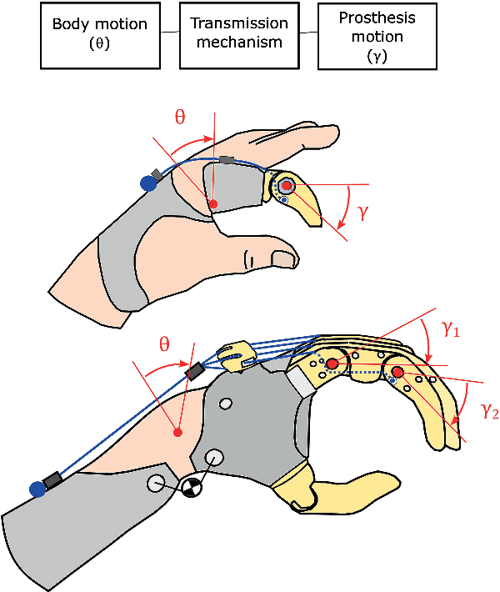 Figure 6 from Treatment of the Partial Hand Amputation: An Engineering ...
