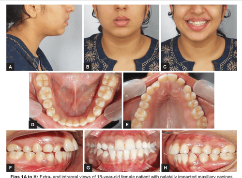 Figure 3 from Treatment of Maxillary Impacted Canine using Ballista ...