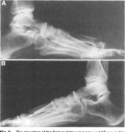 Table 1 from Role of Metatarsus Primus Elevatus in the Pathogenesis of ...