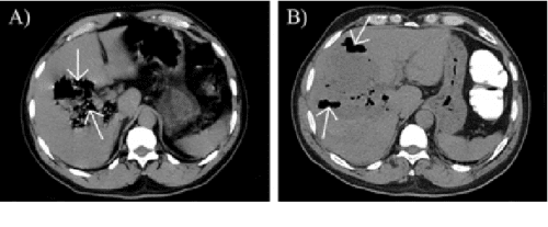 Figure 2 from Intrahepatic Air: Pneumobilia vs. Portal Venous Gas ...