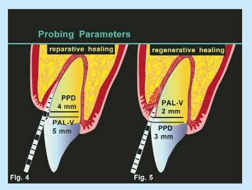 [PDF] Clinical Periodontal Diagnosis : Probing Pocket Depth , Vertical ...