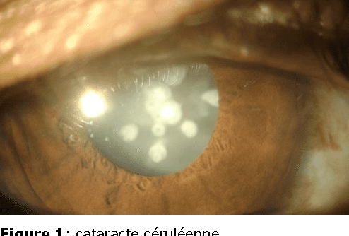 Figure 1 from Un cas de cataracte céruléenne congénitale | Semantic Scholar
