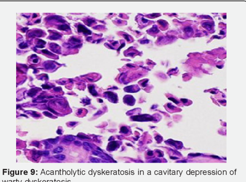 Figure 11 from Corps Ronds and Corps Grains-Warty Dyskeratoma ...