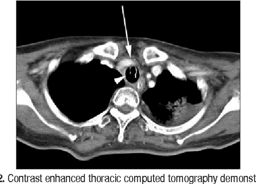 Figure 4 from Successful Treatment of Tracheoinnominate Artery Fistula ...