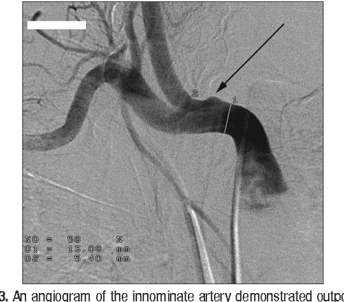 Figure 2 from Successful Treatment of Tracheoinnominate Artery Fistula ...