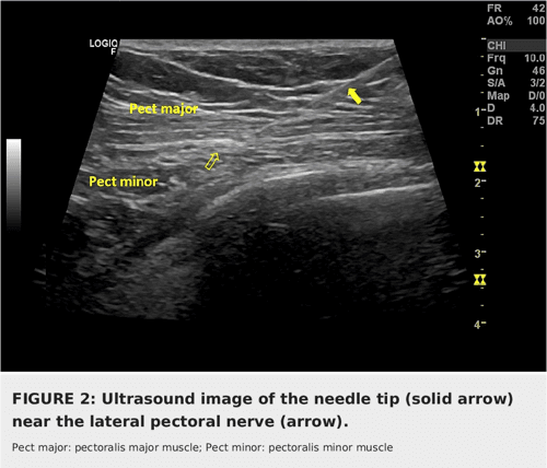 [PDF] Ultrasound-Guided Lateral Pectoral Nerve Pulsed Radiofrequency in a Patient With ...