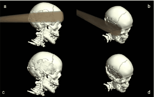Figure 1 from Biomechanical Examination of Blunt Trauma due to Baseball ...